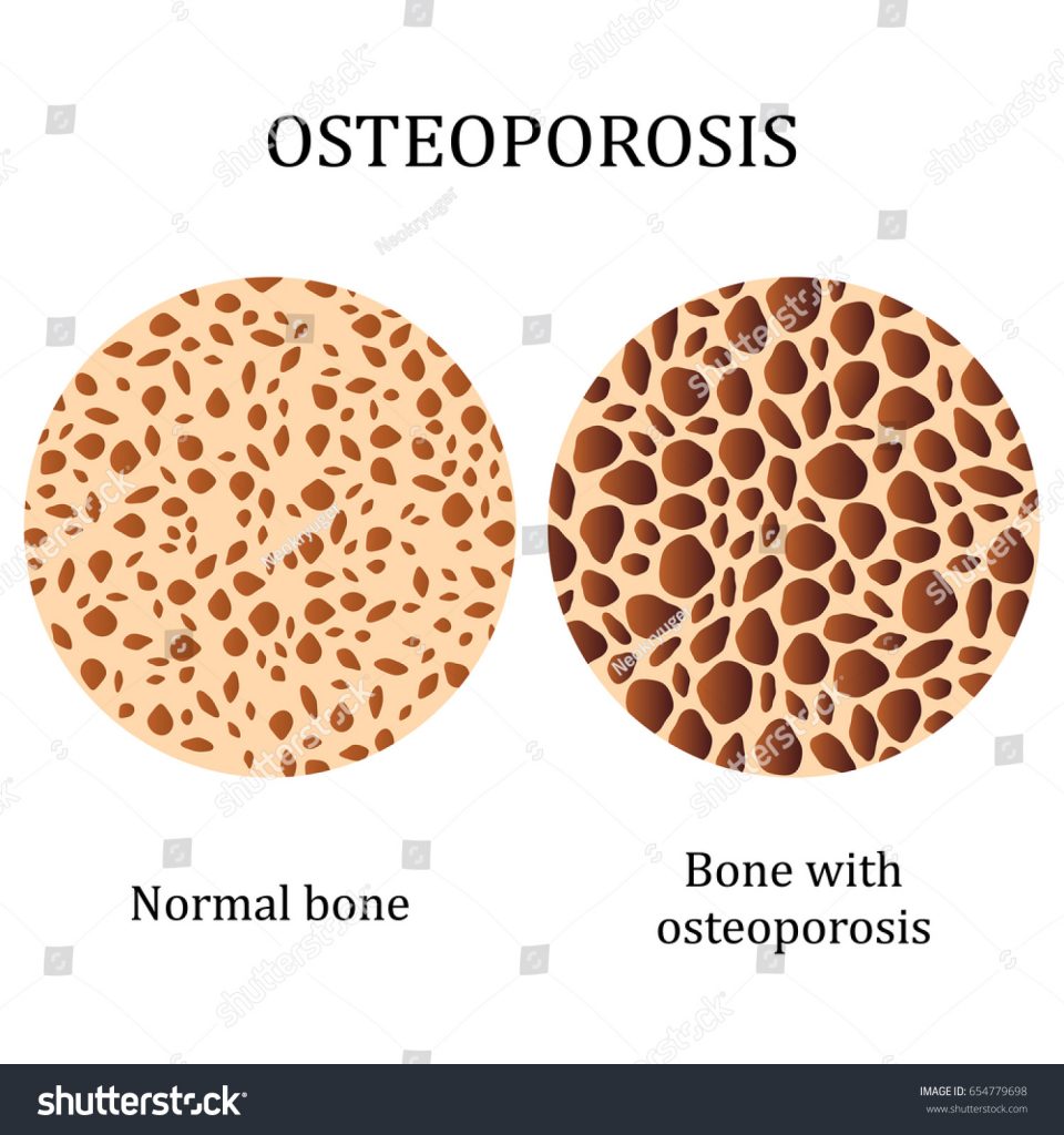 » Bone strength is enhanced by “sun supplementation,” without harming ...